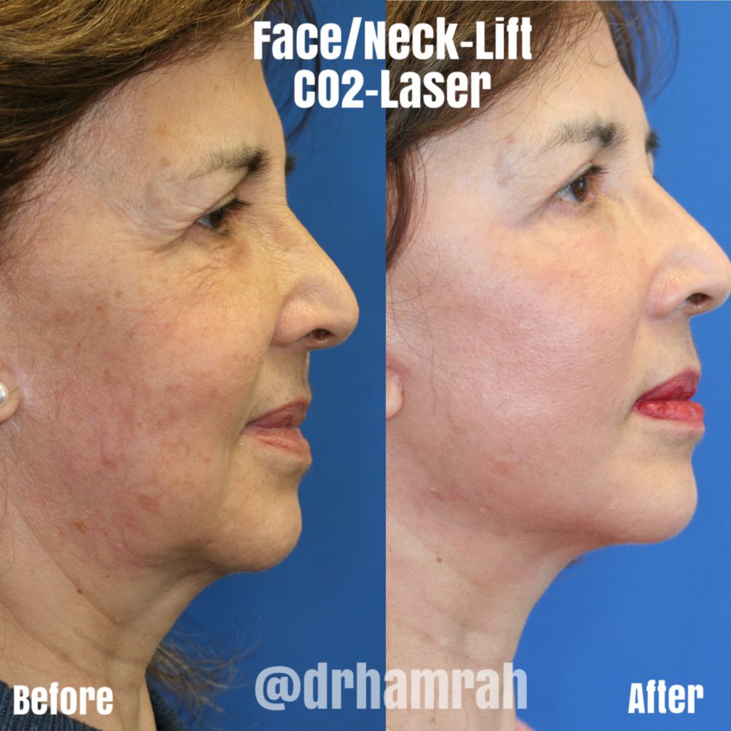 Facelift Before and After Photos - Hamrah, Daria (novasurgicare.com)